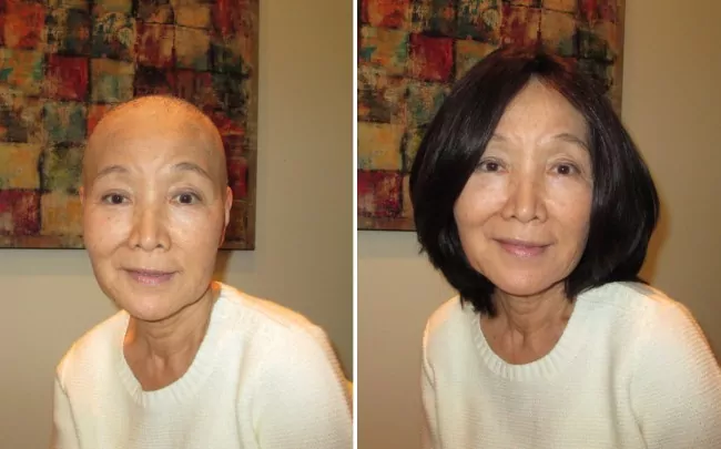 Cranial Prosthesis - Before-After Photos | Newport Hair Loss Center ...