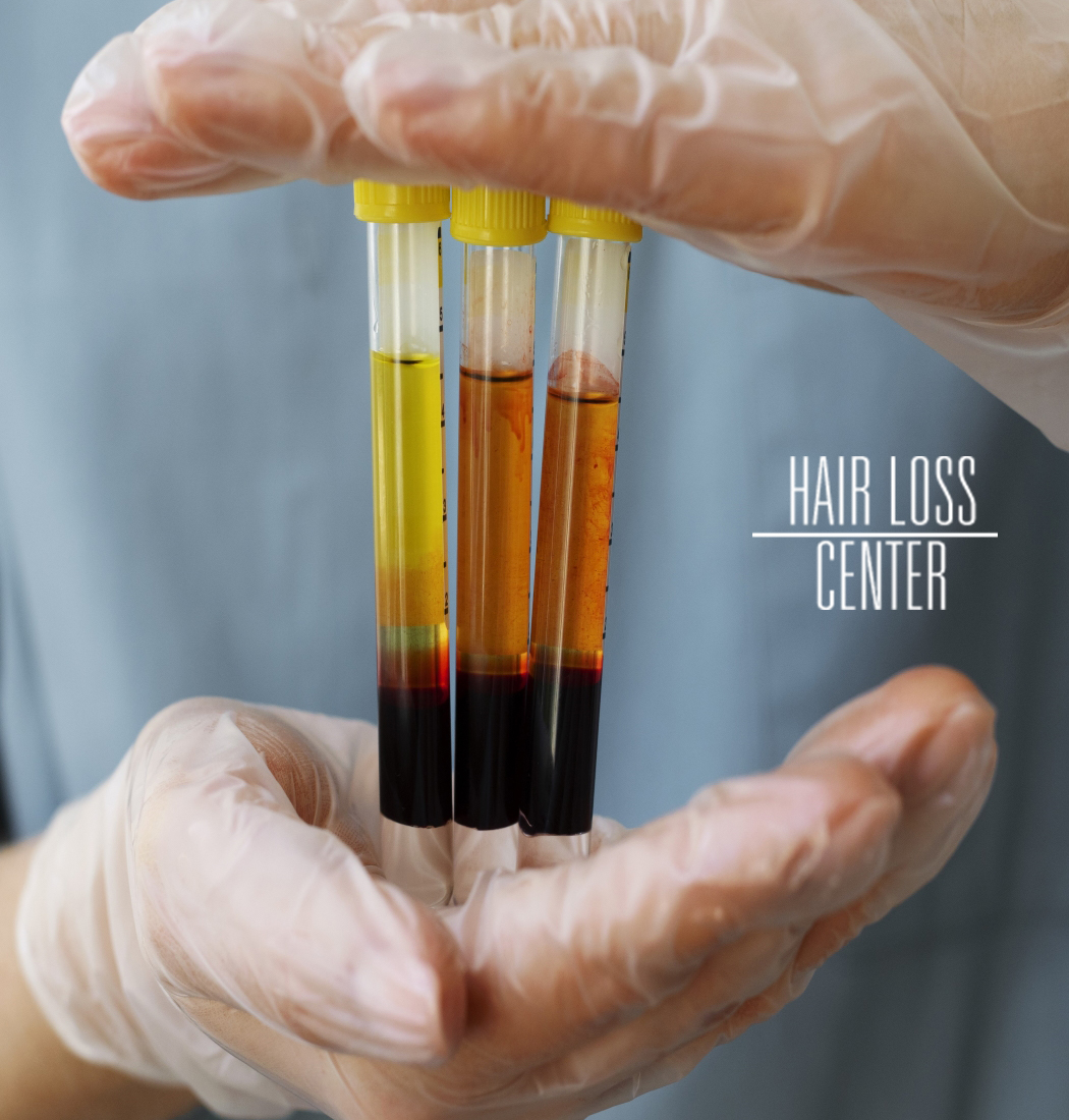 Everything about PRP Injection for Hair Restoration